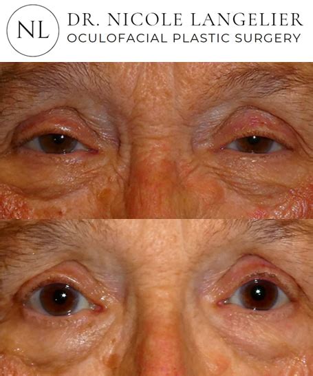Ptosis Repair Richmond Droopy Eyelid Correction Virginia