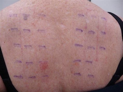 Patch Testing Het Hele Verhaal 1986 Tot 2022 Anton De Groot Ton De Groot