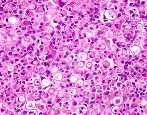 Signet Ring Cell Carcinoma Of The Colon Light Micrograph Stock Image