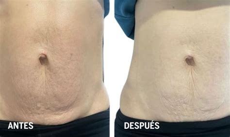 Antes Y Después En Fisioterapia Dermatofuncional Blog Nus