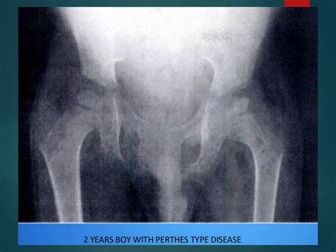 Tuberculosis Of Hip Joint Ppt
