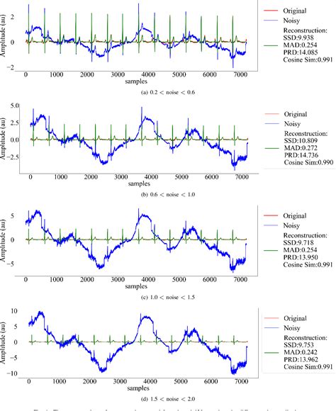 Descod Ecg Deep Score Based Diffusion Model For Ecg Baseline Wander