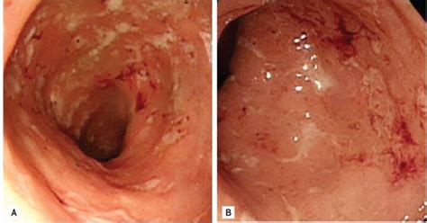 Endoscopic Findings Of Sigmoid Colon Mucosa Showed That The Mucosa Was