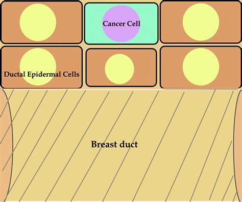 Ductal Carcinoma In Situ Stage 0 Of The Breast 6 Download