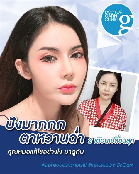 💙 คุณนุ๊กนิค เดิมก่อนทำตา หน้าดุ ดวงตาดุ หนังตาหย่อน 💙 คุณนุ๊กนิค เดิมก่อนทำตา หน้าดุ