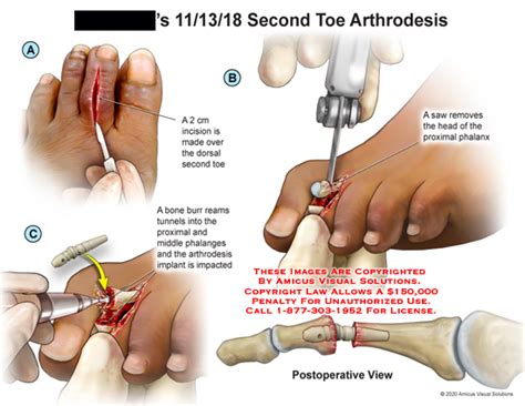 Second Toe Arthrodesis