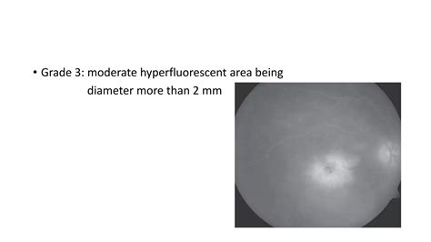Ffa And Icga In Posterior Uveitis Pptx