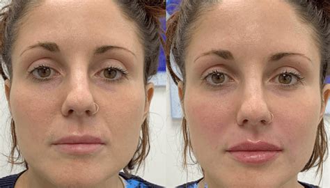 Cupids Bow Lip Everything You Need To Know Ams Aesthetics