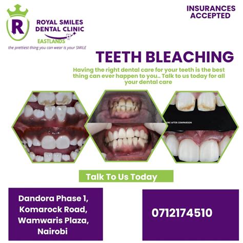 Teeth Bleaching Royal Smiles Dental Clinic Eastlands