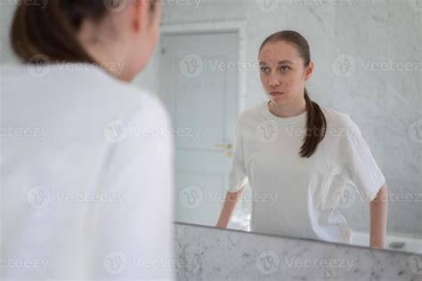 Gen Z Woman Looking At Her Acne And Post Acne Marks Stands Before A Mirror In Bathroom Concept