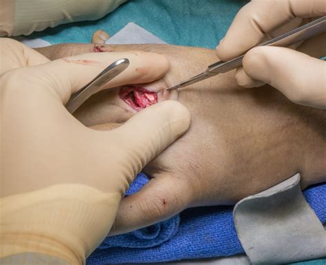 Extensor Tendon Repair In Zone 5 Of The Hand Orthoracle Luanmd