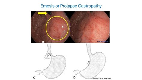 Emesis Or Prolapse Gastropathy Endocollab