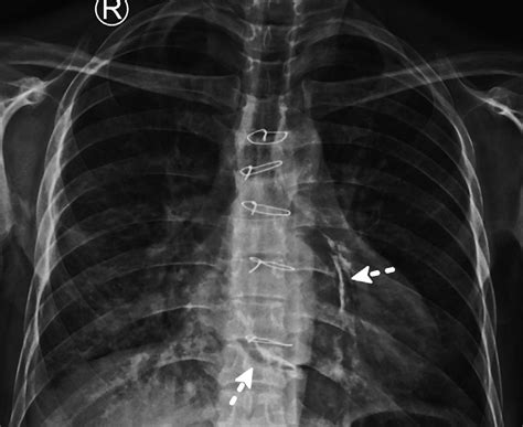 Chest X Ray Showed A Ring Shaped Pericardial Calcification Dashed