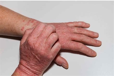 Best Eczema Creams For Eczema And Tsw