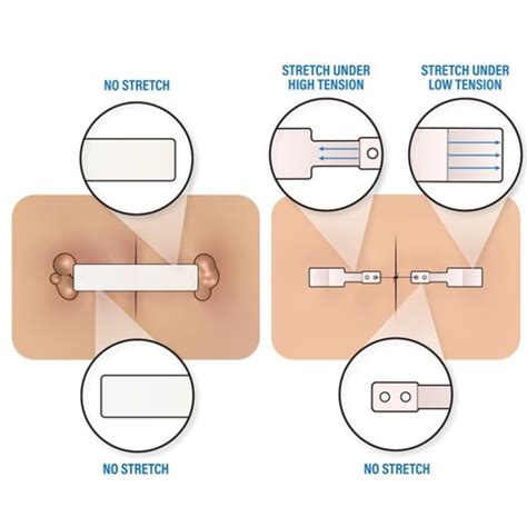 Suturegard® Medical Inc On Linkedin Mohs Hemigard Retentionsuture