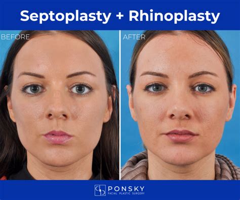 Deviated Septum Surgery Everything You Need To Know