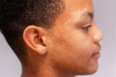Causes Of Skin Discoloration Artofit