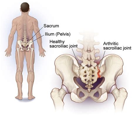 Sacroiliac Joint Dysfunction Sijd Pinnacle Vitality Rehab