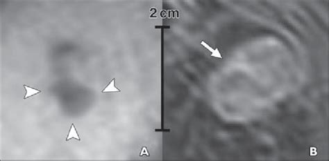 Examples Of Pathologic Lymph Nodes A T2 Weighted Haste Image In Download Scientific Diagram
