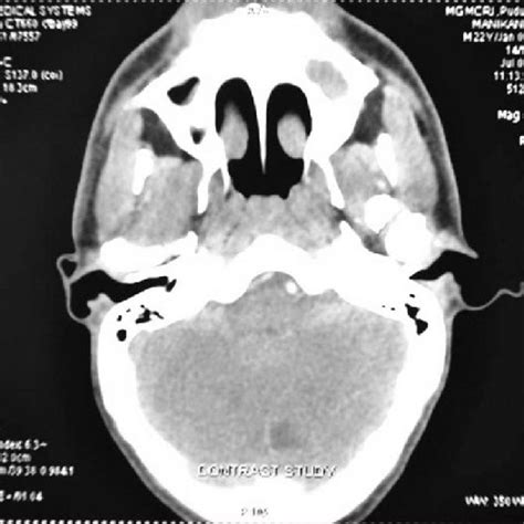 Ct Axial Section Shows Well Defined Hyperdense Mass In The Left Tmj