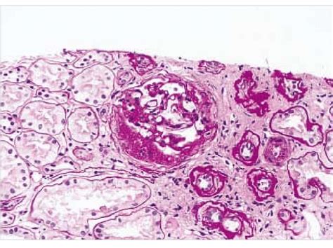 This Glomerulus Shows Segmental Sclerosis Pas Stain × 200
