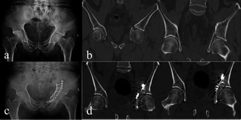 Effect Of O Arm On Reduction Quality And Functional Recovery Of