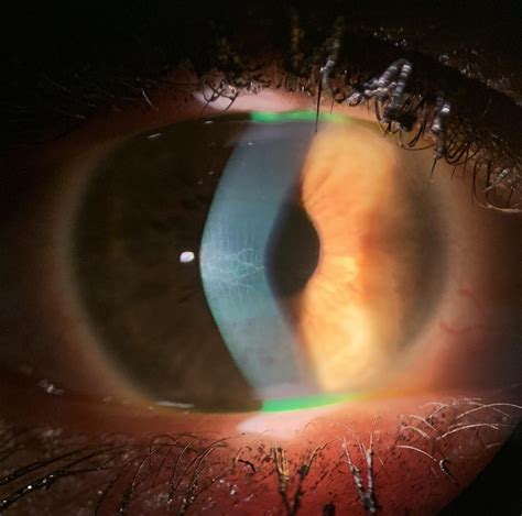 Keratoconus With Corneal Scarring Roptometry
