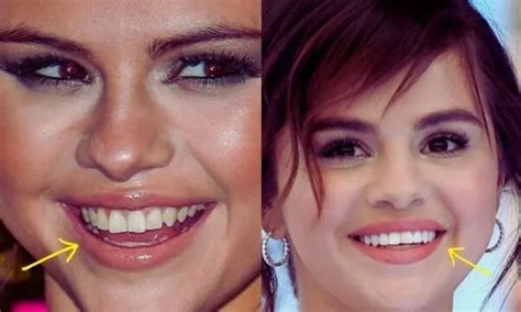 Selena Gomez Veneers Letsmedi