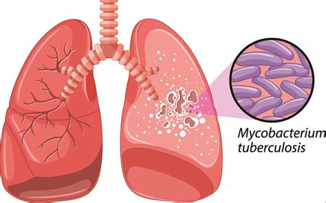 Sek 24 Million To Research On Tuberculosis And Antibiotic Resistance