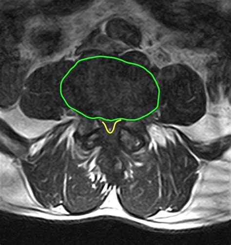 Ligamentum Flavum Hypertrophy Mri Thomas J Kleeman Md Nh