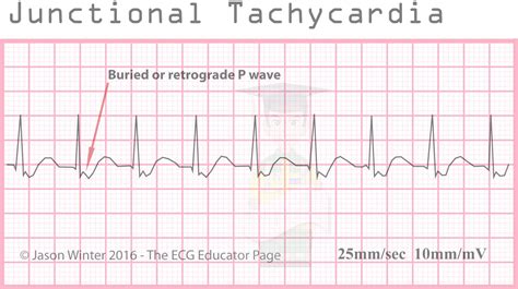 Junctional Escape Rhythm Strip