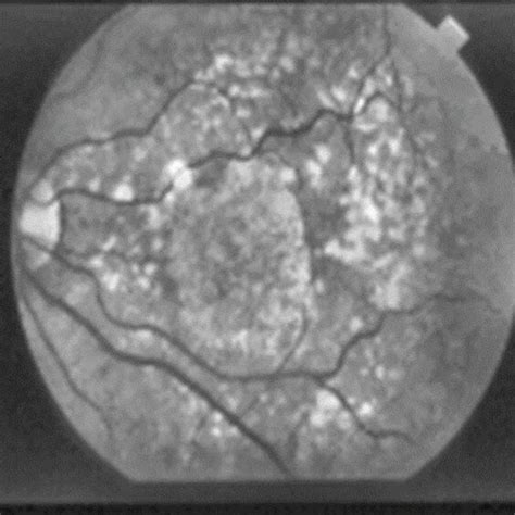 Work Flow Of Glaucoma Detection Download Scientific Diagram