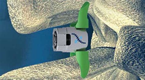 Dr Richard Gayles Superion Indirect Decompression System Is Safe Effective Treatment Space