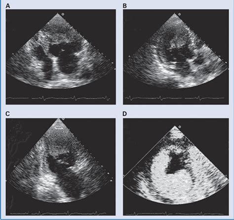 Figure 2 From Primary Left Ventricular Cardiac Sarcoma Semantic Scholar