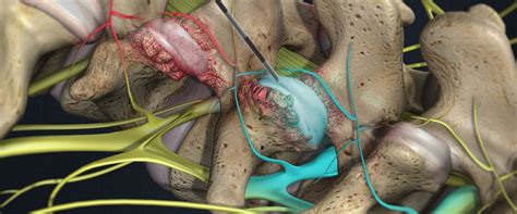 What Are The Alternatives When Facet Joint Injections Dont Work