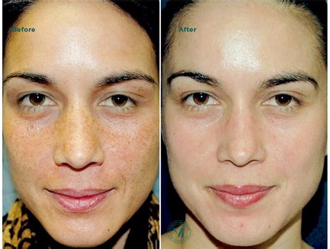 Best Melasma Treatments Atlanta And Sandy Springs Ga July 2026