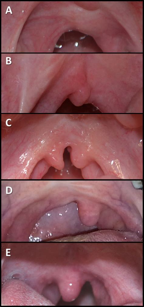 Healthy Uvula Two