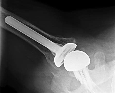 Uw Shoulder And Elbow Academy Reverse Total Shoulder Choosing A Prosthesis