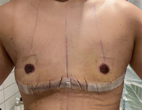 Seeking Advice Dealing With Post Op Seroma 9days After Surgery R