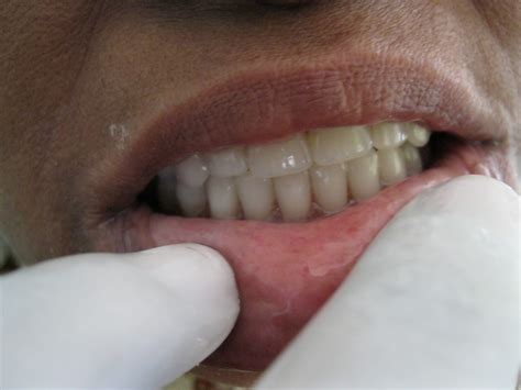 Dento Care Dental Clinics Sunflex Complete Denture