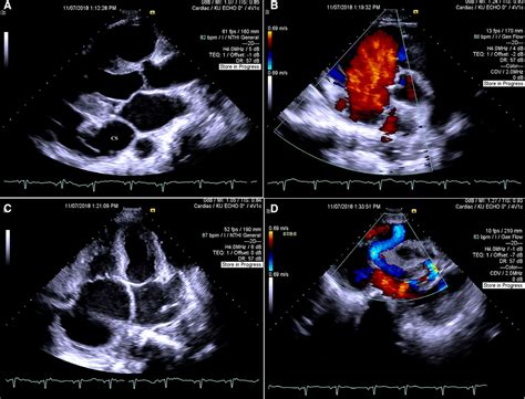 Multimodality Imaging In Preparation For Successful Surgical Correction