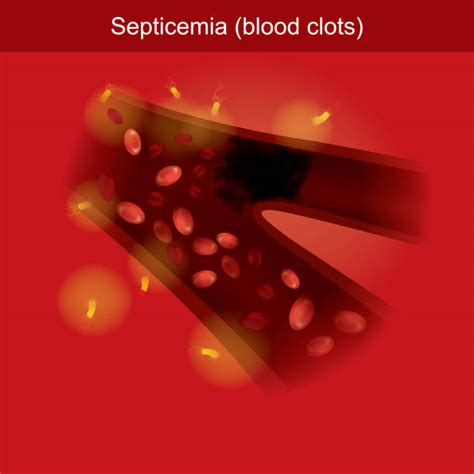 Sepsis Illustrations Royalty Free Vector Graphics And Clip Art Istock