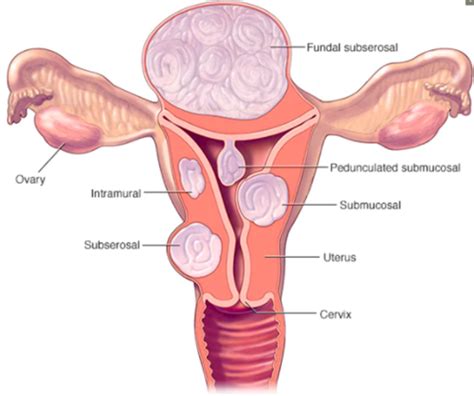 Uterine Pathology Flashcards Quizlet
