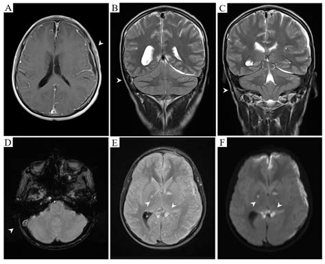 Streptococcus Meningitis Case Report At William Wickens Blog