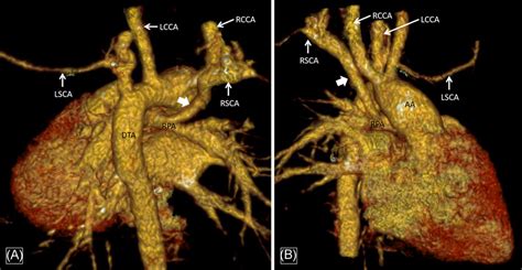 Ab Volume‐rendered Images Show The Isolated Rsca Connected To The