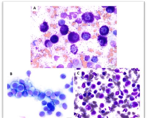 Cutaneous Histiocytoma Presence Of Tumor Cells Arranged In Cords And