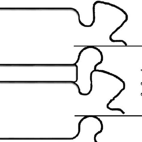Very High Migrated Lumbar Disc Herniation A Disc Migration That Download Scientific Diagram