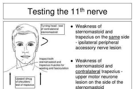 8411 Eleventh Spinal Accessory External Branch Cranial Nerve Neuralgia