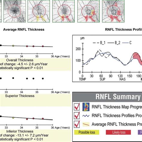 A B Example Of Agreement Detecting Glaucomatous Progression Between