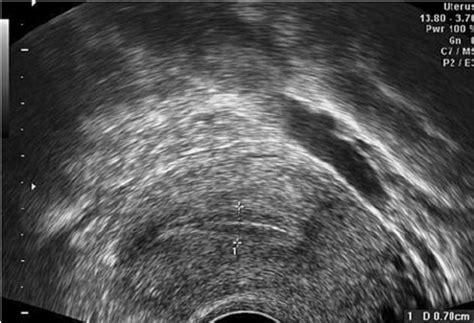 Endovaginal Ultrasonography Endometrium Thickness Single Layer My Xxx